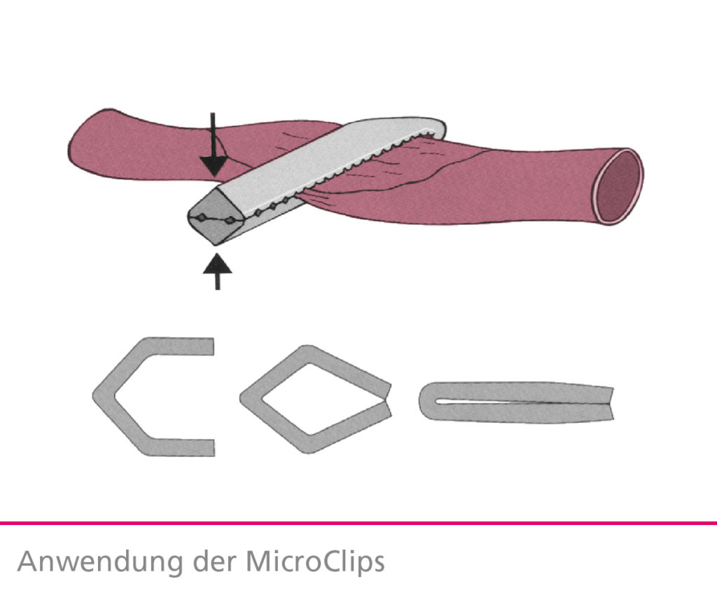 MicroClips - TapMed Medizintechnik