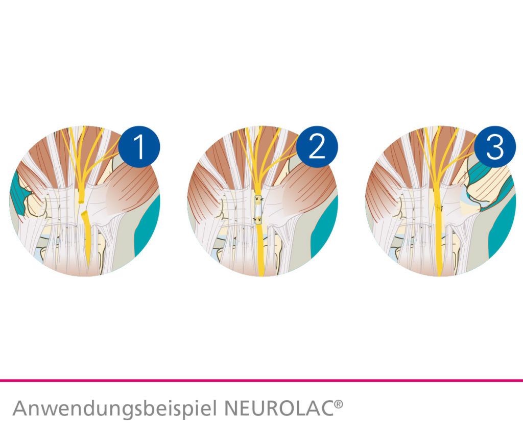 NEUROLAC - TapMed Medizintechnik