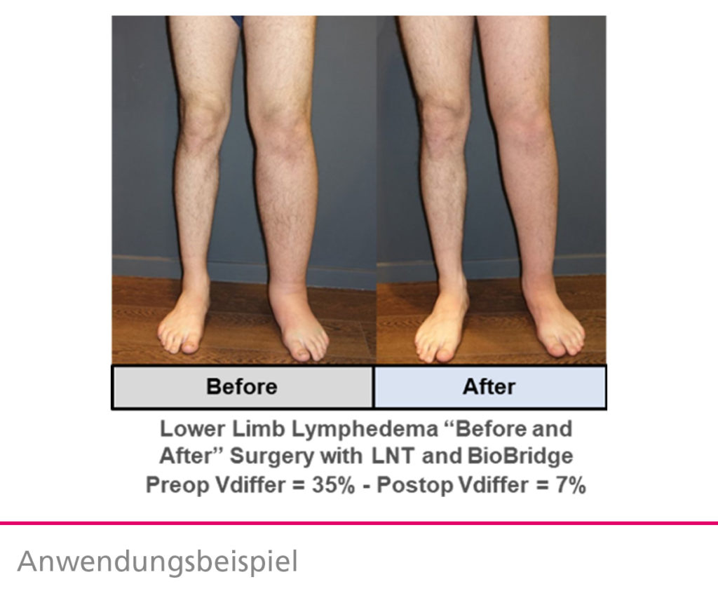 BioBridge® Kollagenmatrix - TapMed Medizintechnik